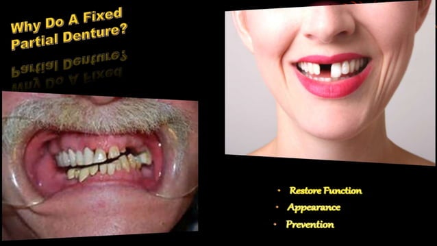 Introduction to fixed prosthodontics | PPT