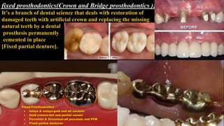 Introduction to fixed prosthodontics | PPTX