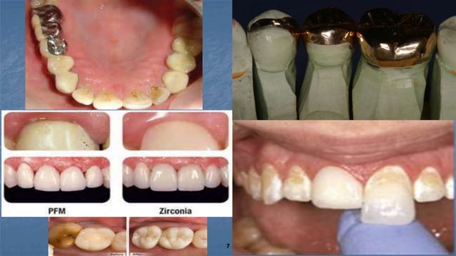 Introduction to fixed prosthodontics | PPT