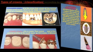 Introduction to fixed prosthodontics | PPTX