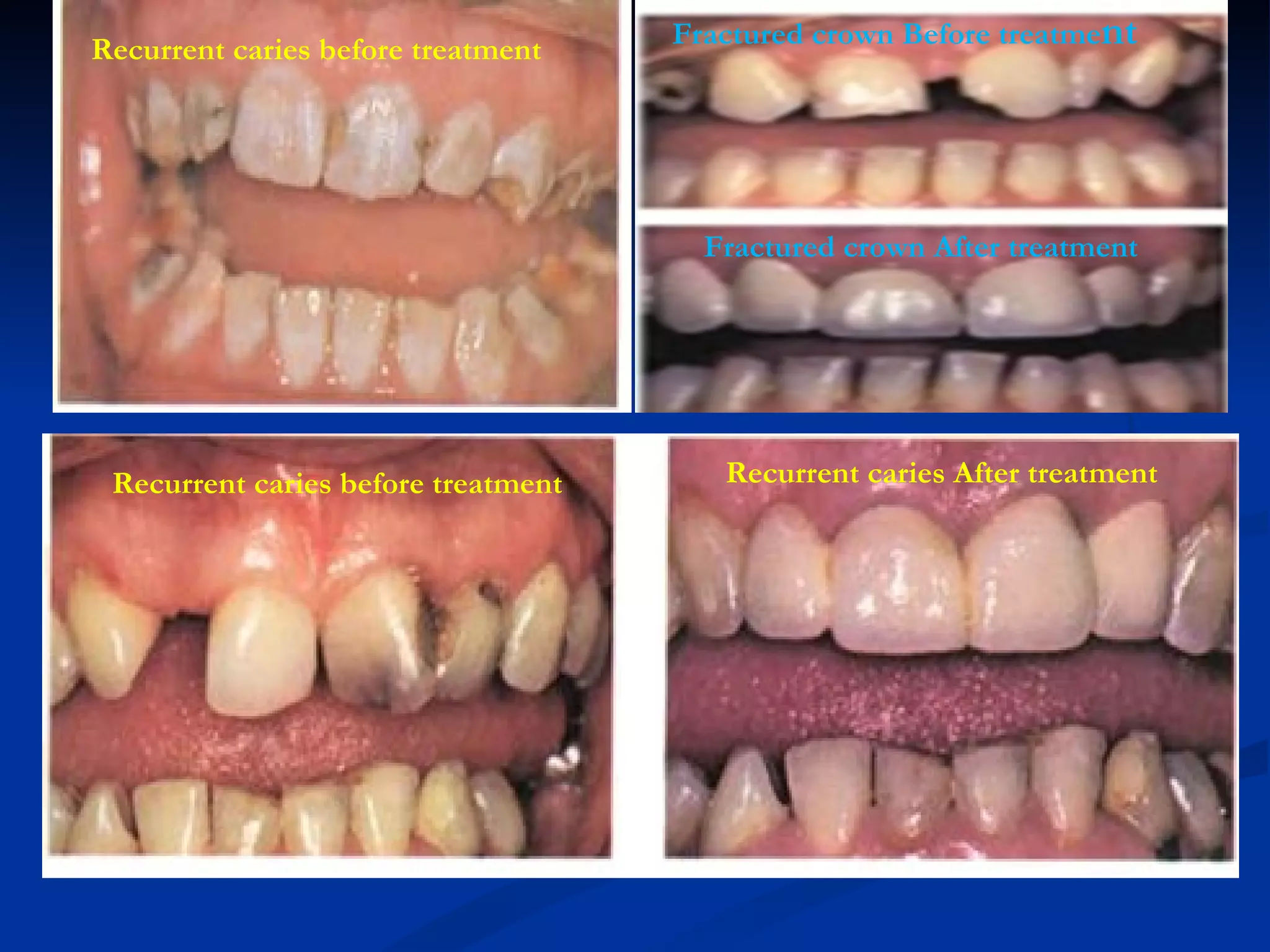 Introduction to fixed prosthodontics | PPT