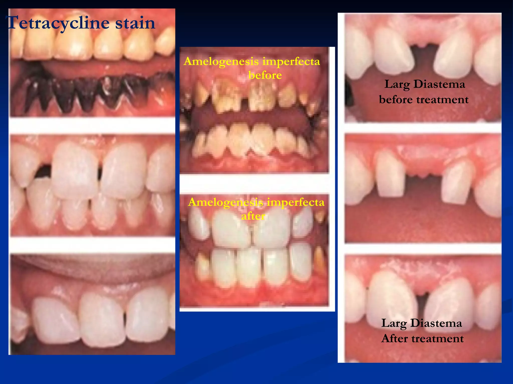Introduction to fixed prosthodontics | PPT