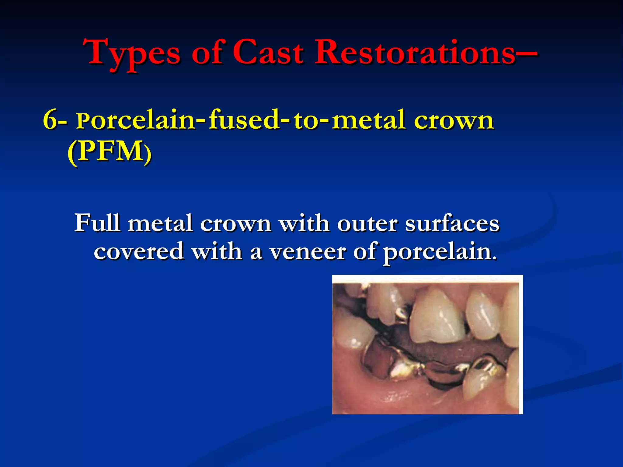 Introduction to fixed prosthodontics | PPT