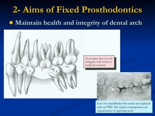 Introduction to fixed prosthodontics | PPT