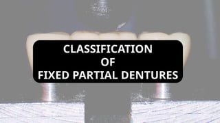 Introduction to the Fixed Partial Dentures | PPTX