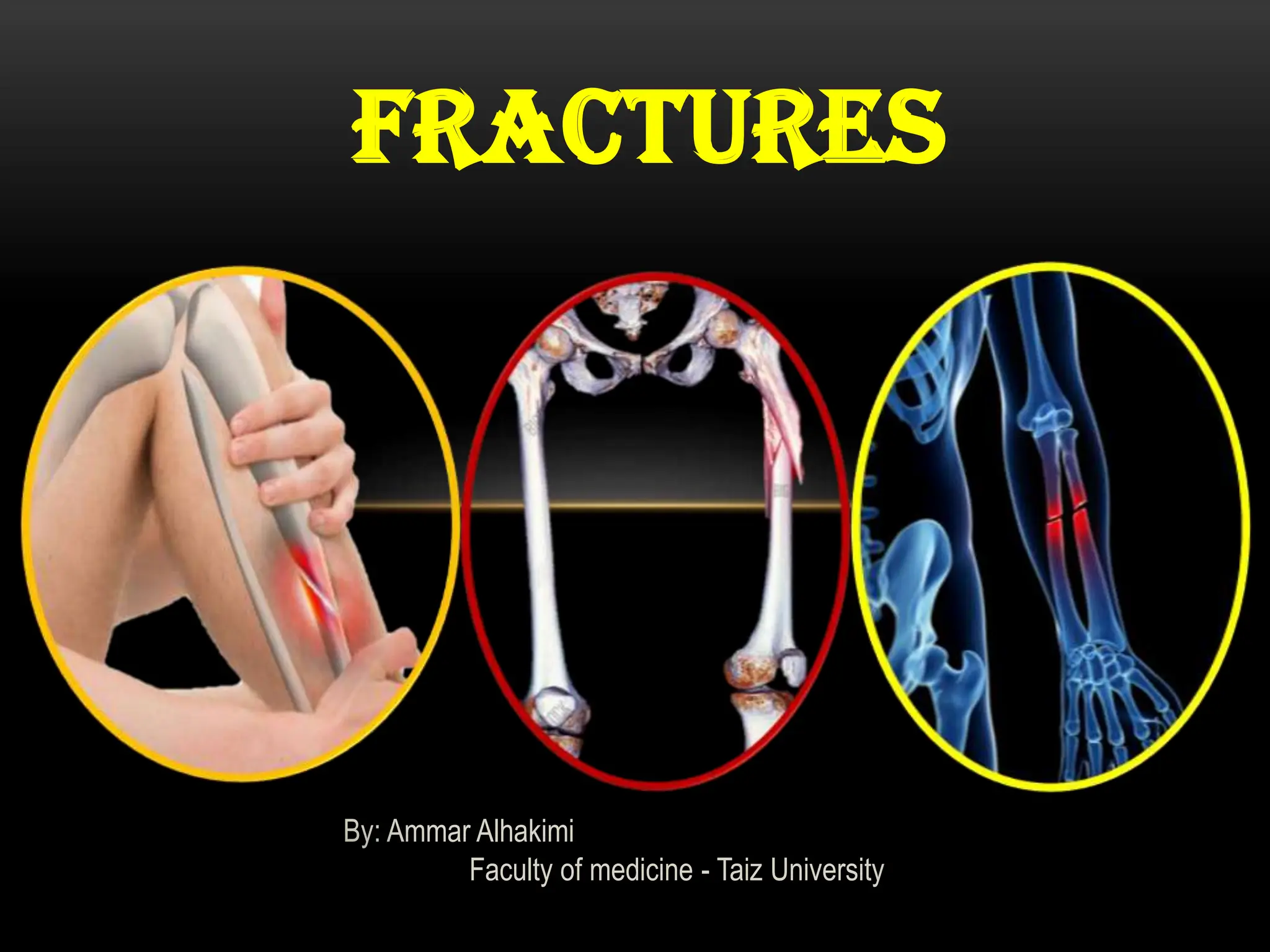 Fractures | PDF