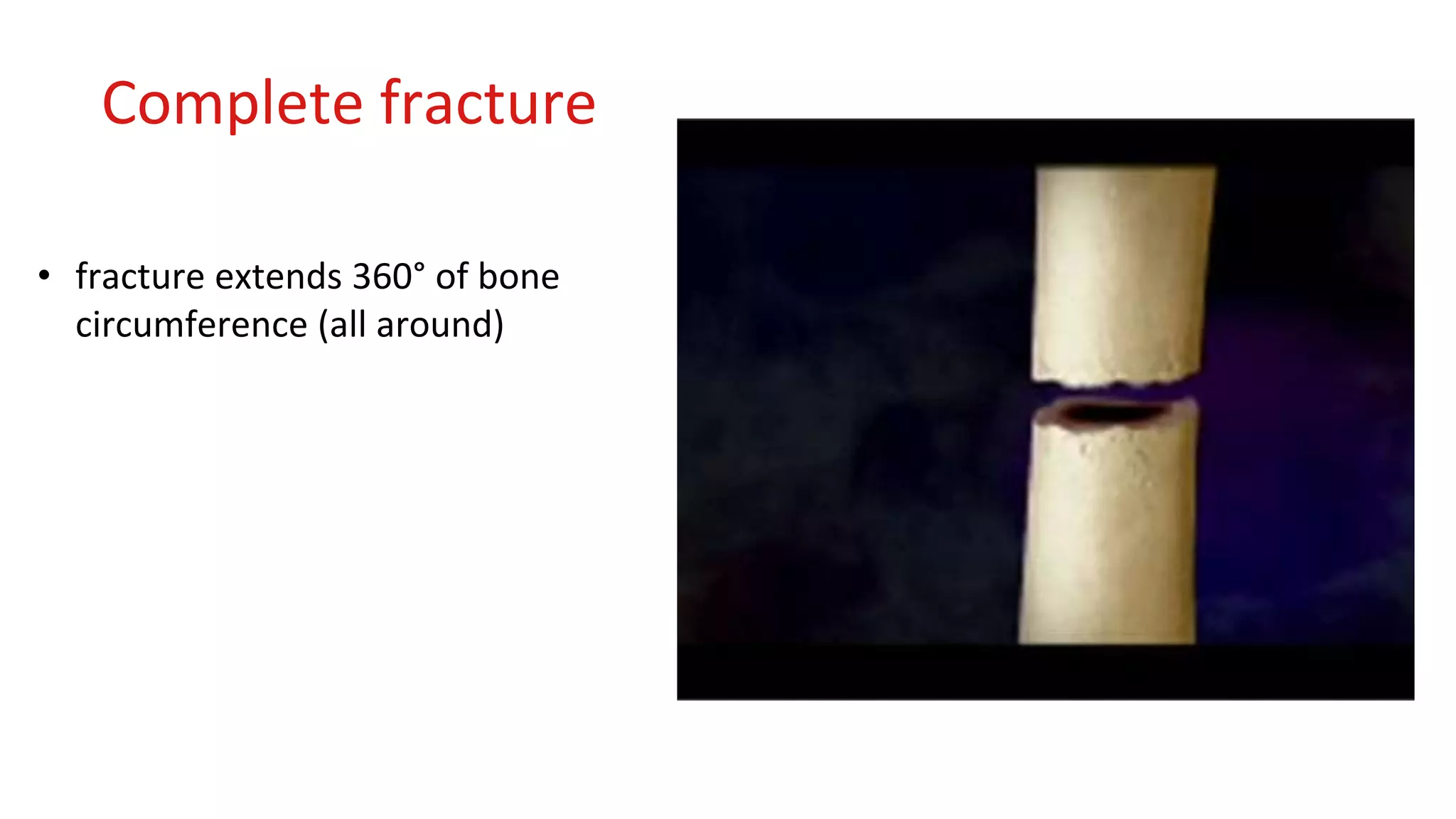 Introduction to fractures | PPTX