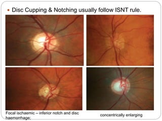 Introduction to glaucoma.pptx