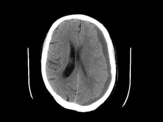 Introduction to head ct | PPTX