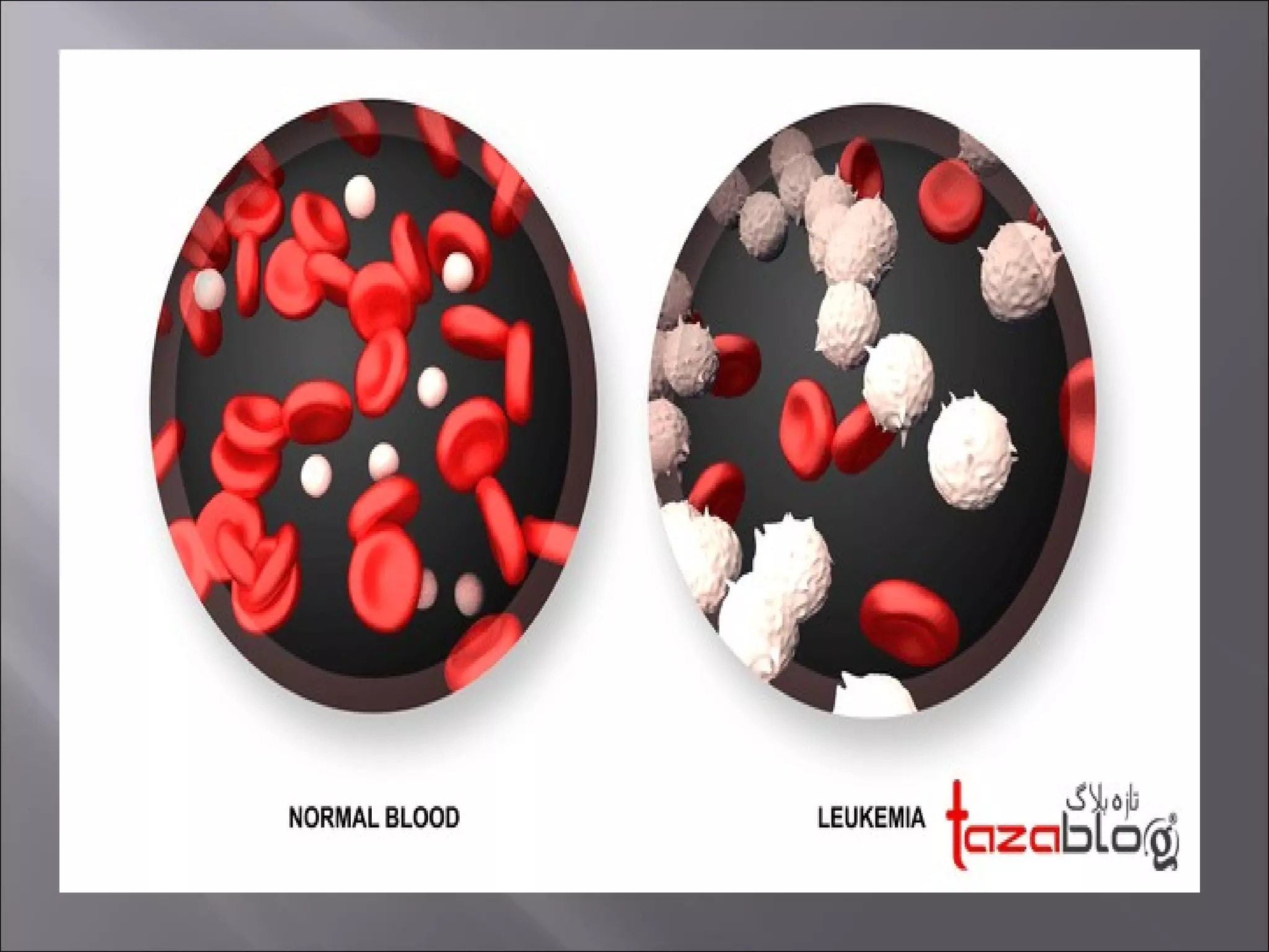 Introduction to leukemia | PPT