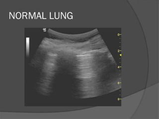 Introduction to Lung Ultrasound | PPTX