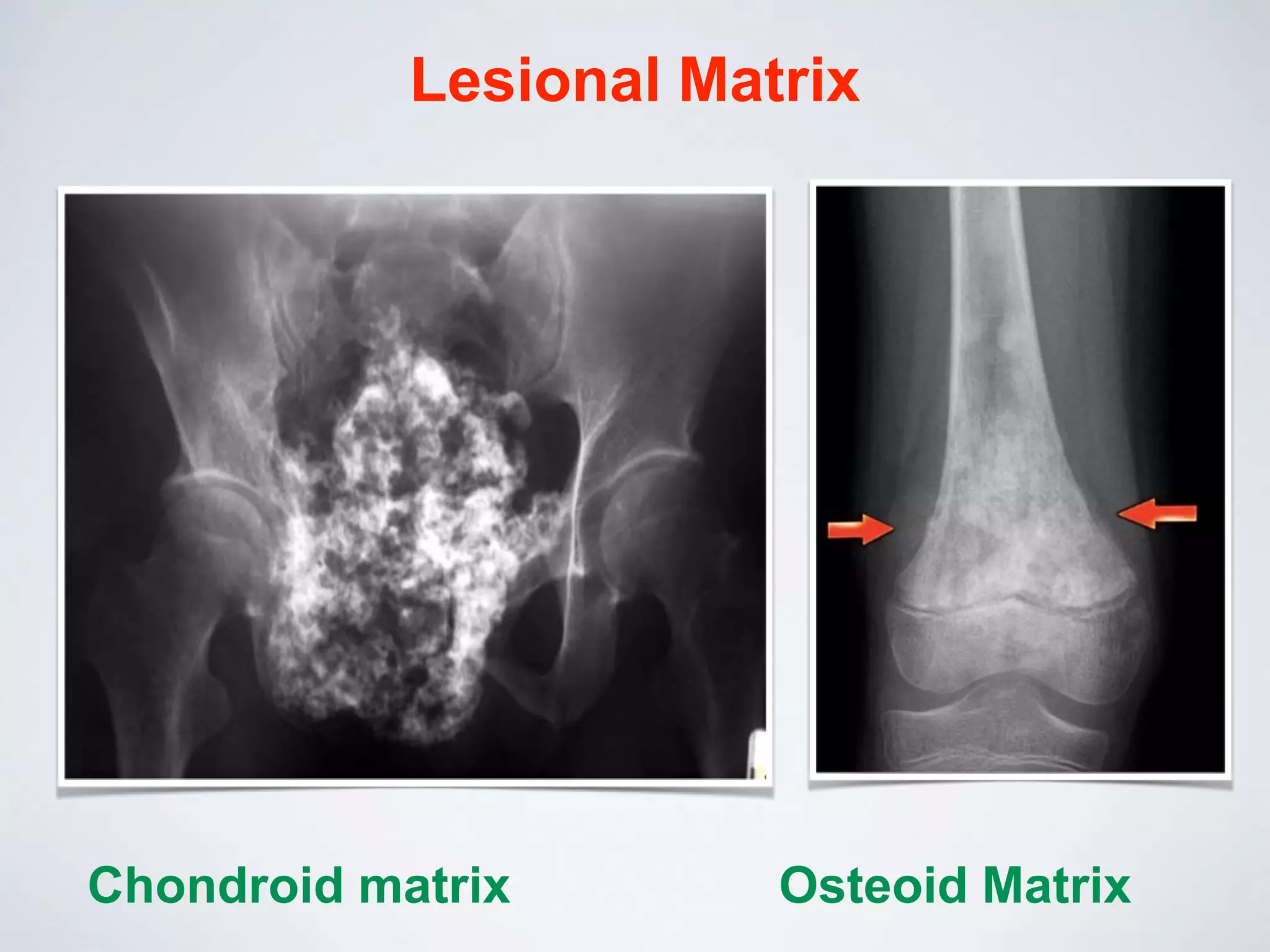 Introduction to muscloskletal tumors | PPTX