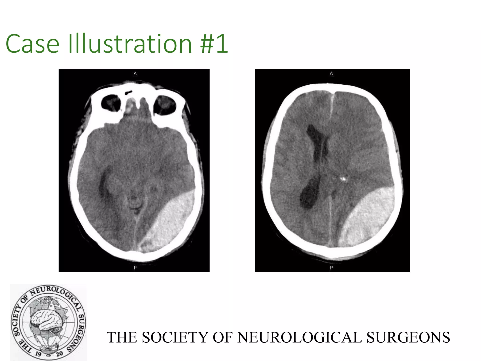 Introduction to Neurosurgical Subspecialties Trauma and Critical Care ...