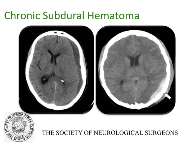 Introduction to Neurosurgical Subspecialties Trauma and Critical Care ...