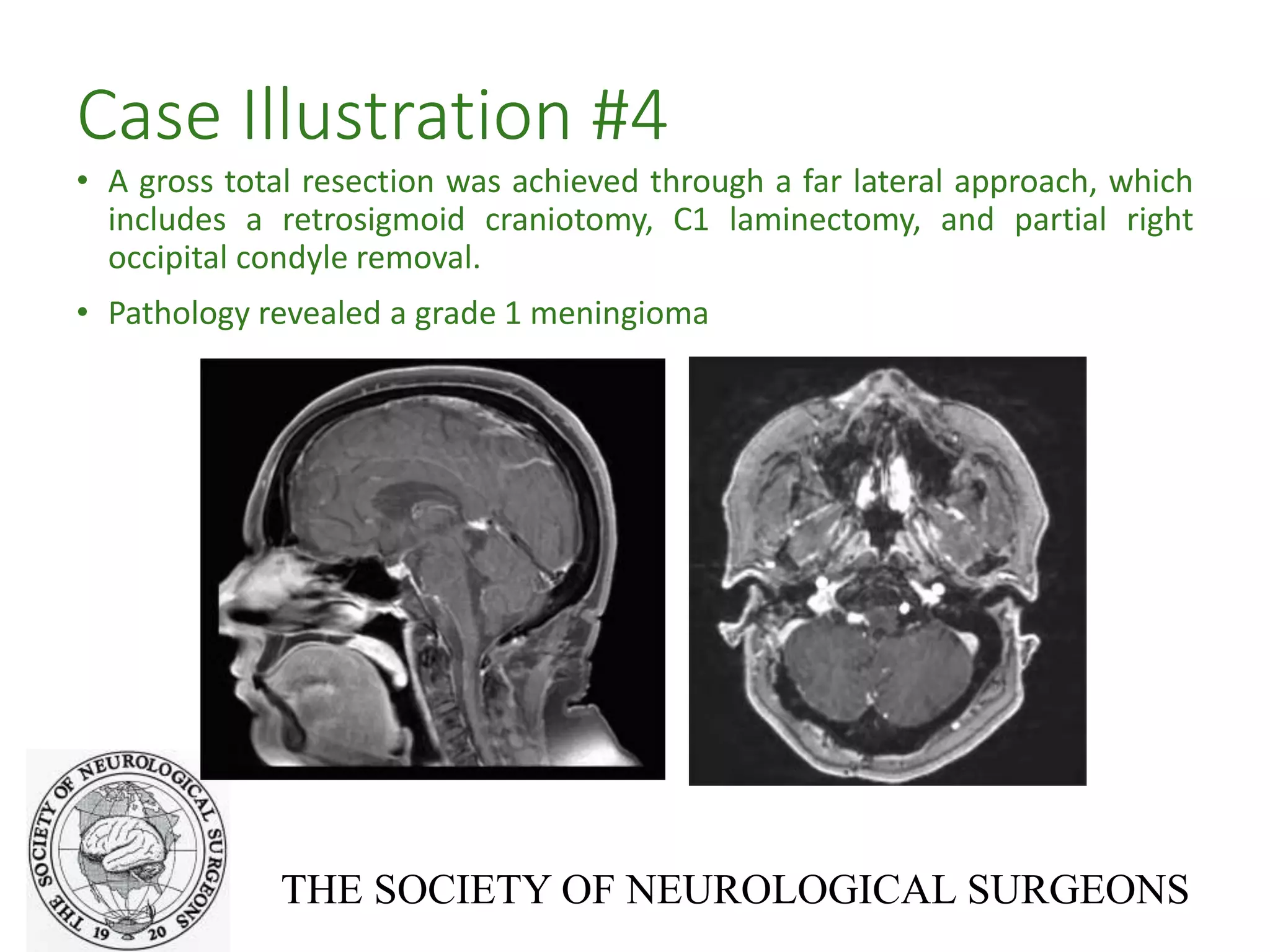 Introduction to Neurosurgical Subspecialties Tumor and Skull Base Neurosurgery.pptx