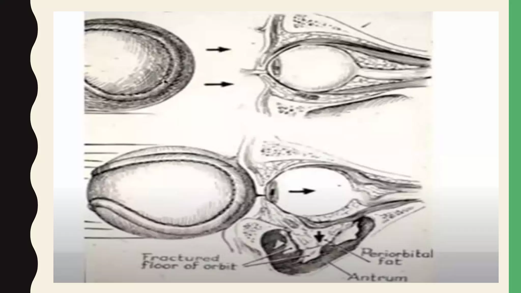 Introduction to ocular trauma Dr. Iddi Slides.pptx