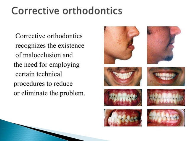 Introduction to orthodontics | PPTX | Dental Health | Diseases and ...