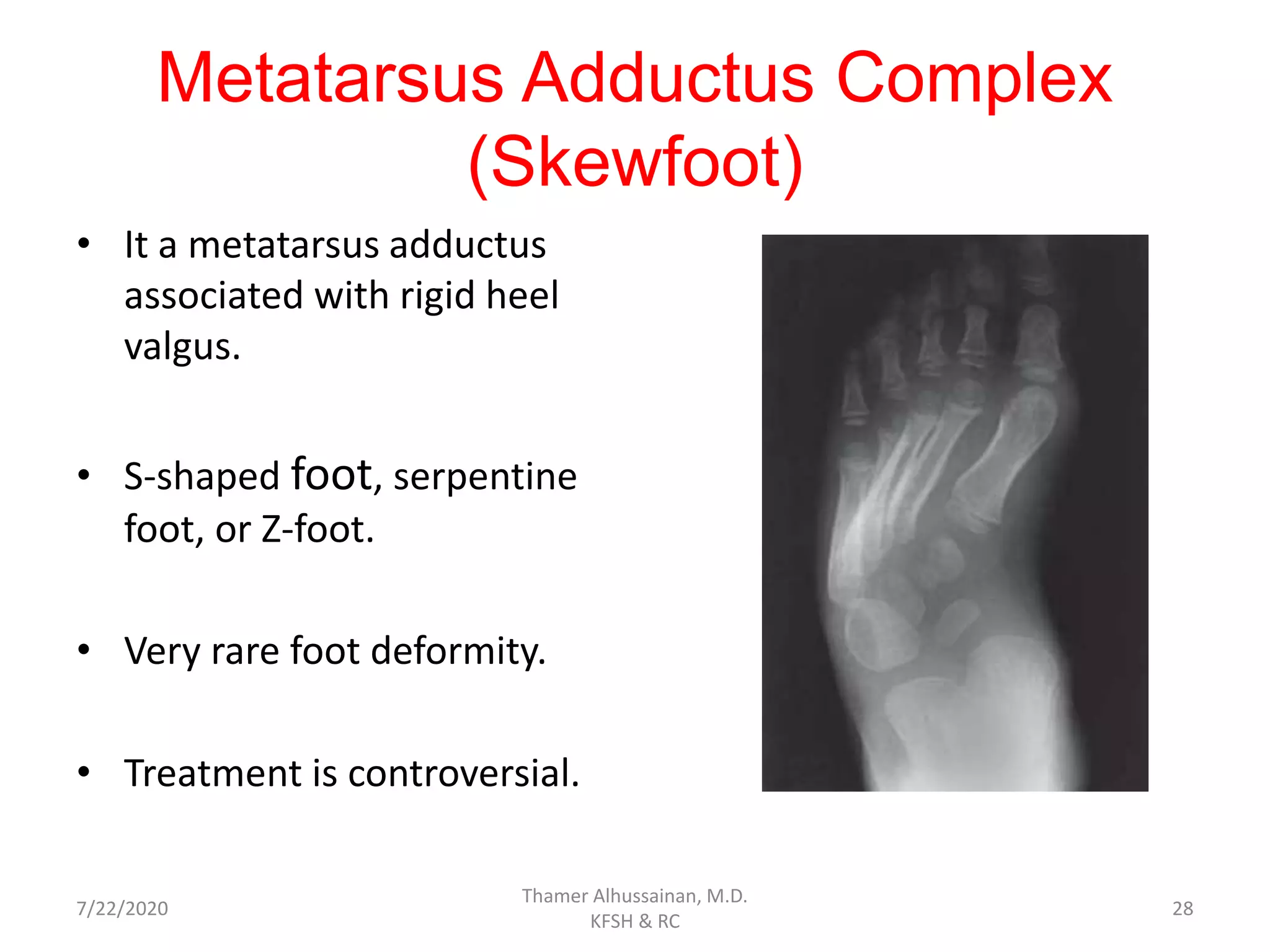 Introduction to pediatric foot | PPTX