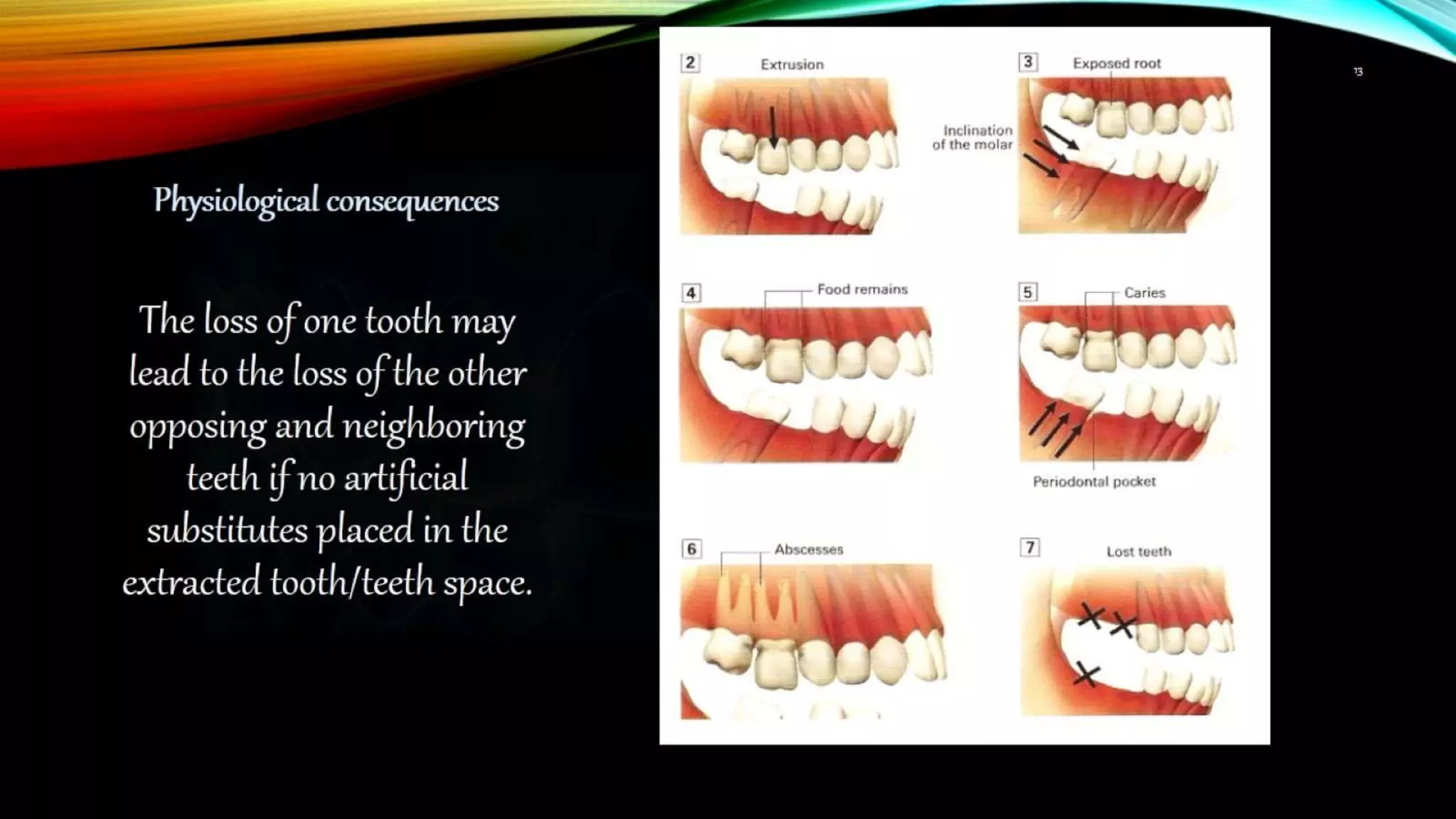 Introduction to prosthodontics | PPTX