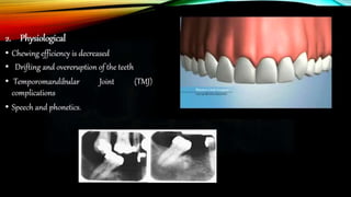 Introduction to prosthodontics | PPTX