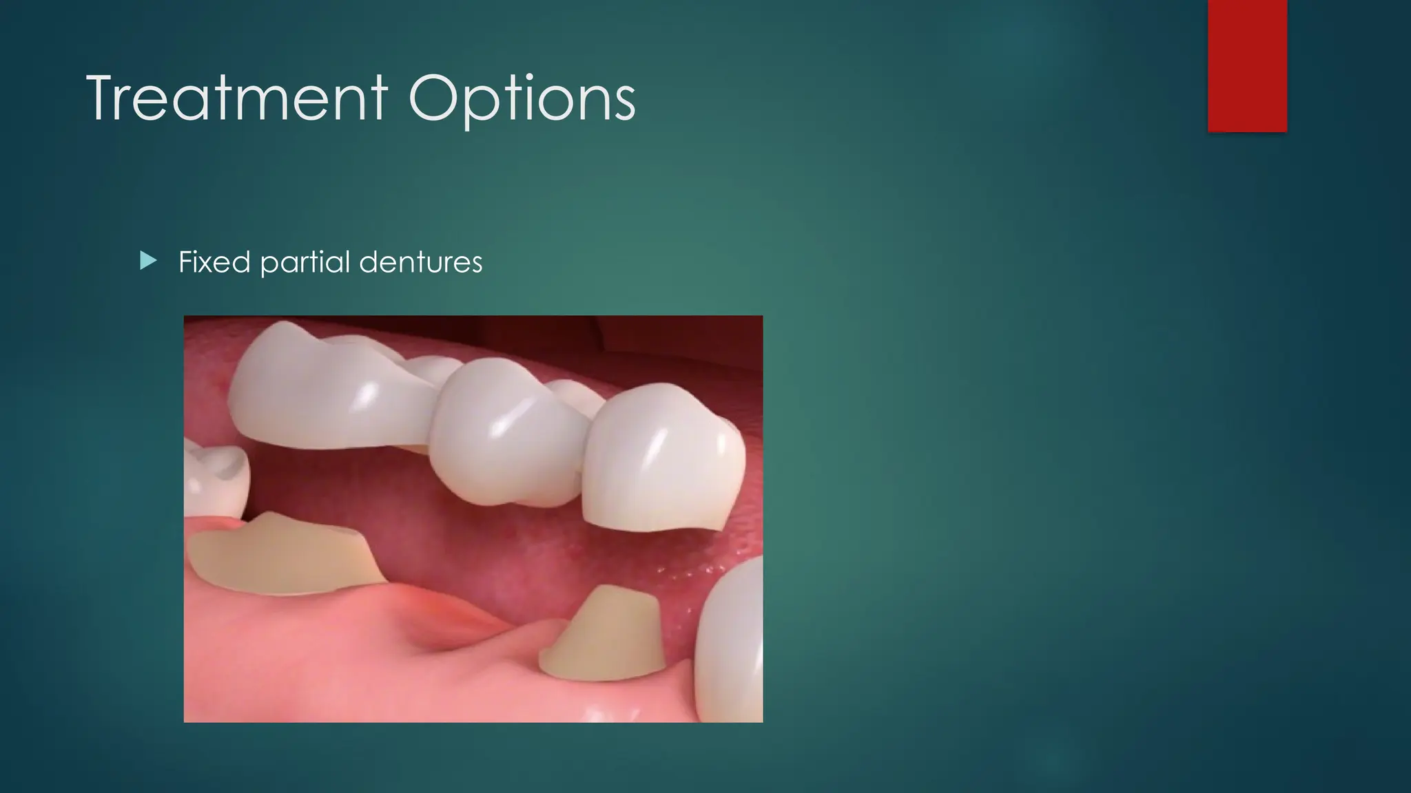 Introduction to Prosthodontics.ppt dentistryx | PPTX
