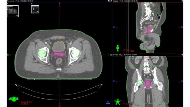 Brief Introduction To Radiation Oncology Pptx