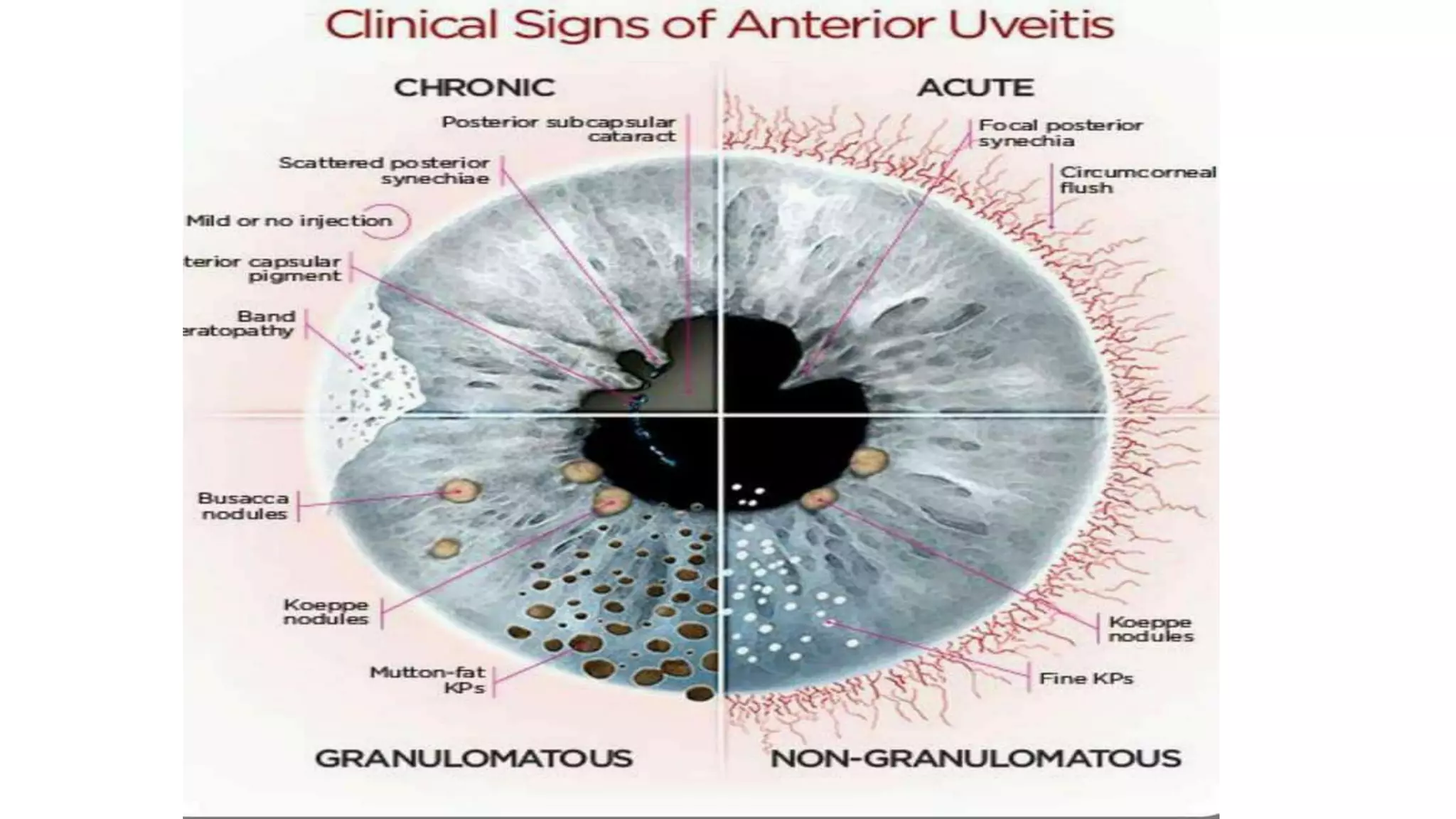Introduction to uveitis | PPTX | Eye and Vision Conditions | Diseases ...
