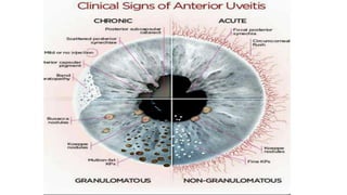 Introduction to uveitis | PPTX