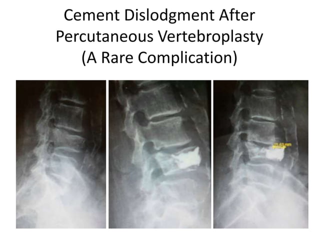 Vertebral Augmentation by Vertebroplasty and Kyphoplasty: Introductory ...