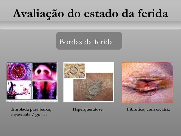 Tratamento de feridas - Aula 02