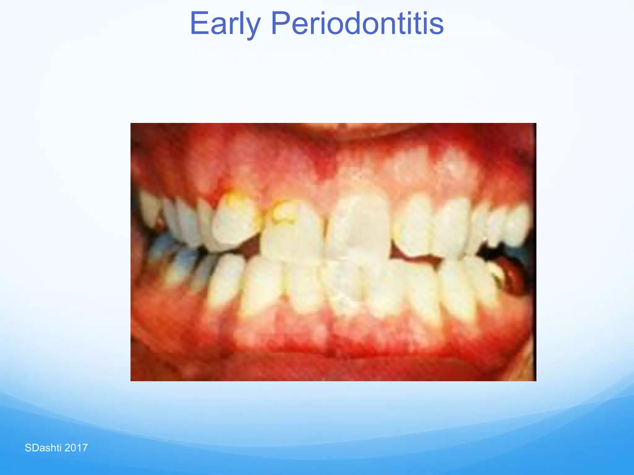 Intro eight gingival and periodontal diseases | PPTX
