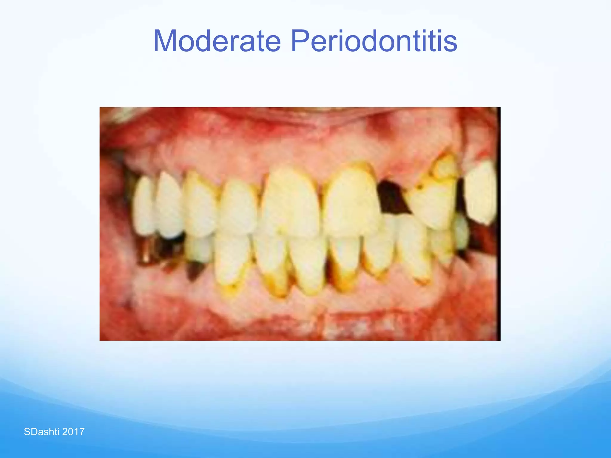 Intro eight gingival and periodontal diseases | PPTX