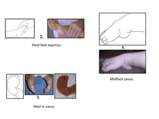 Congenital Tallipes Equino Varus (CTEV) | PPTX