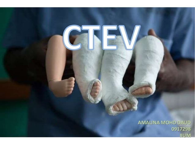 Congenital Tallipes Equino Varus (CTEV)