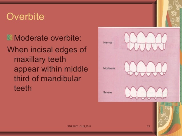 Intro three occlusion