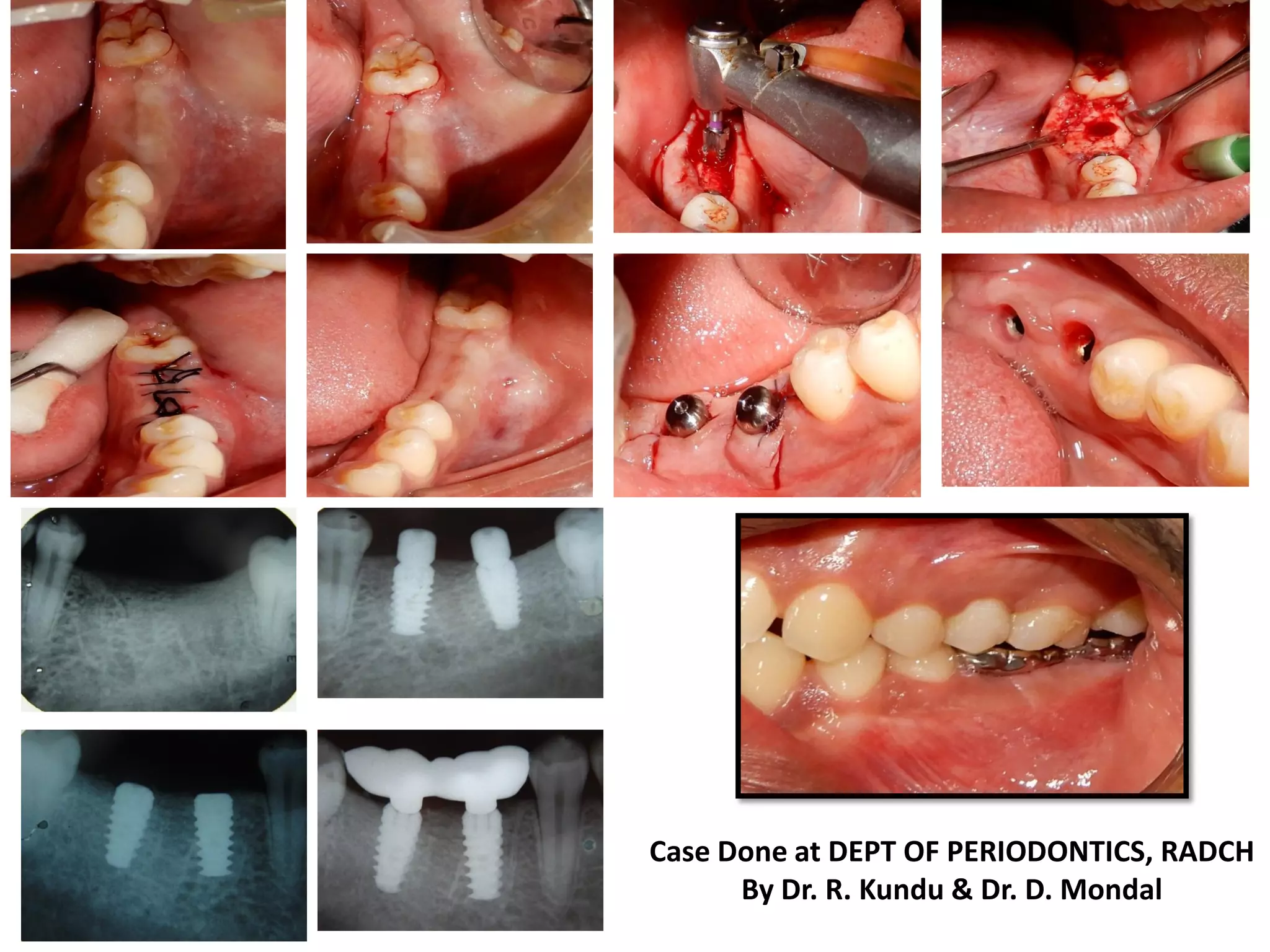 Introduction to Dental Implants | PDF