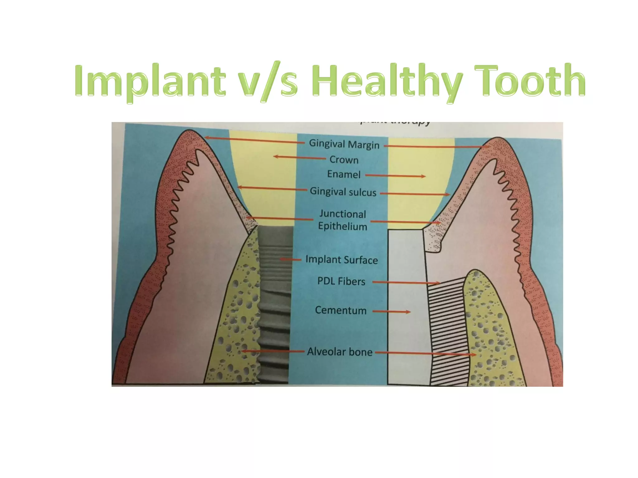 Introduction to Dental Implants | PDF