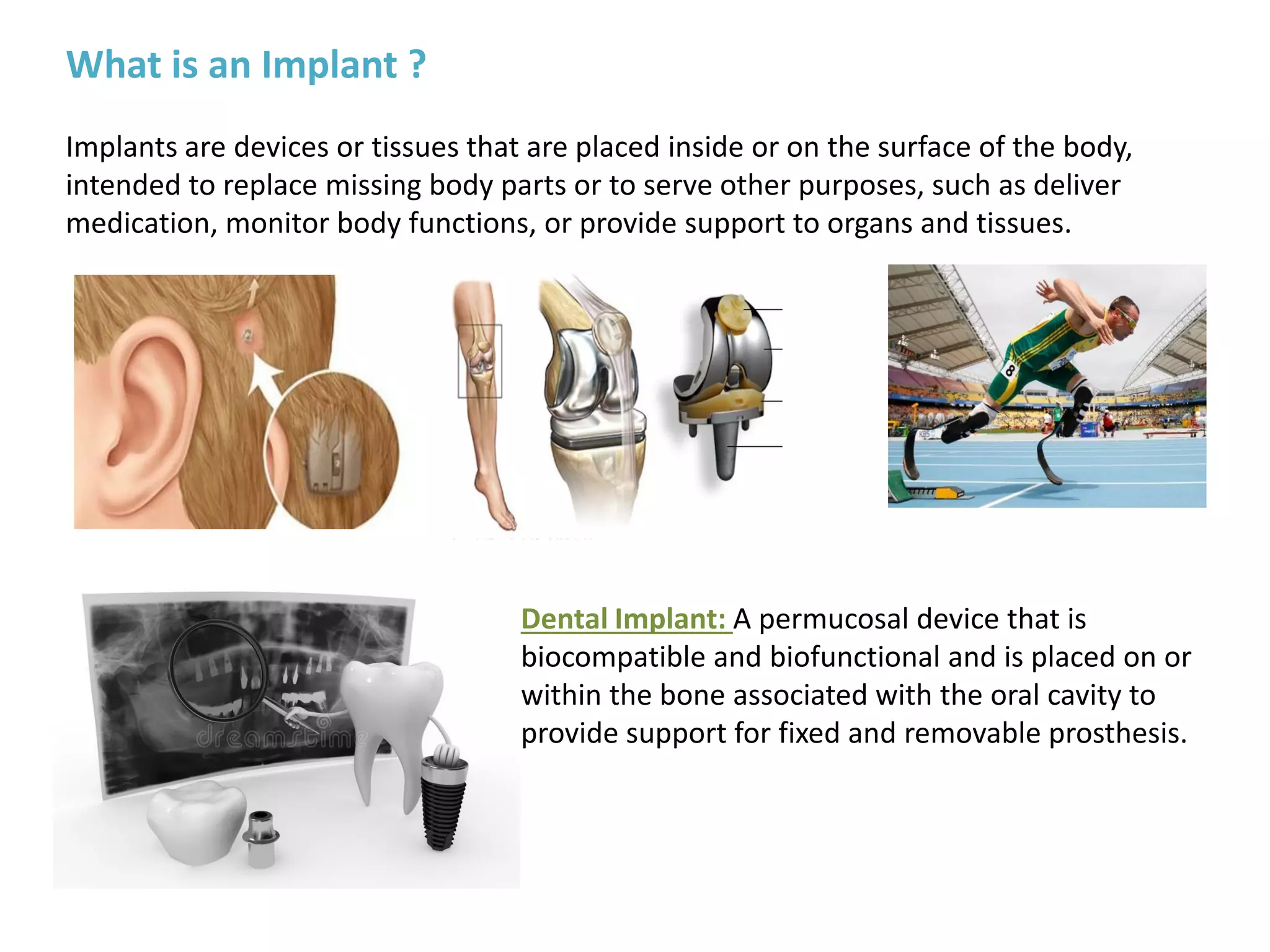 Introduction to Dental Implants | PDF
