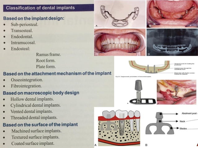 Introduction to Dental Implants | PDF | Bone and Joint Conditions ...