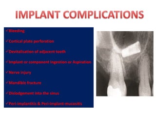 Introduction to Dental Implants | PDF