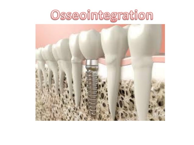 Introduction to Dental Implants | PDF | Bone and Joint Conditions ...