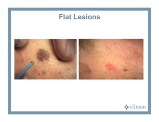 Intro to Ellman Part 2/5 (Derm) | PDF