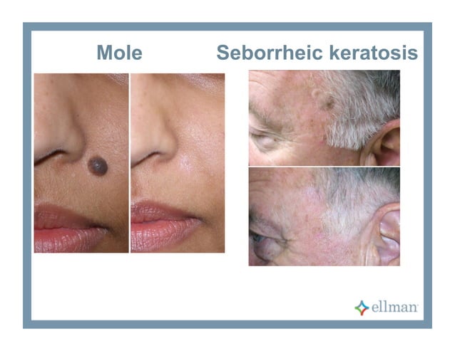 Intro to Ellman Part 2/5 (Derm) | PDF | Skin and Dermatology | Diseases ...