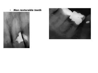 Intro to endodontics | PDF