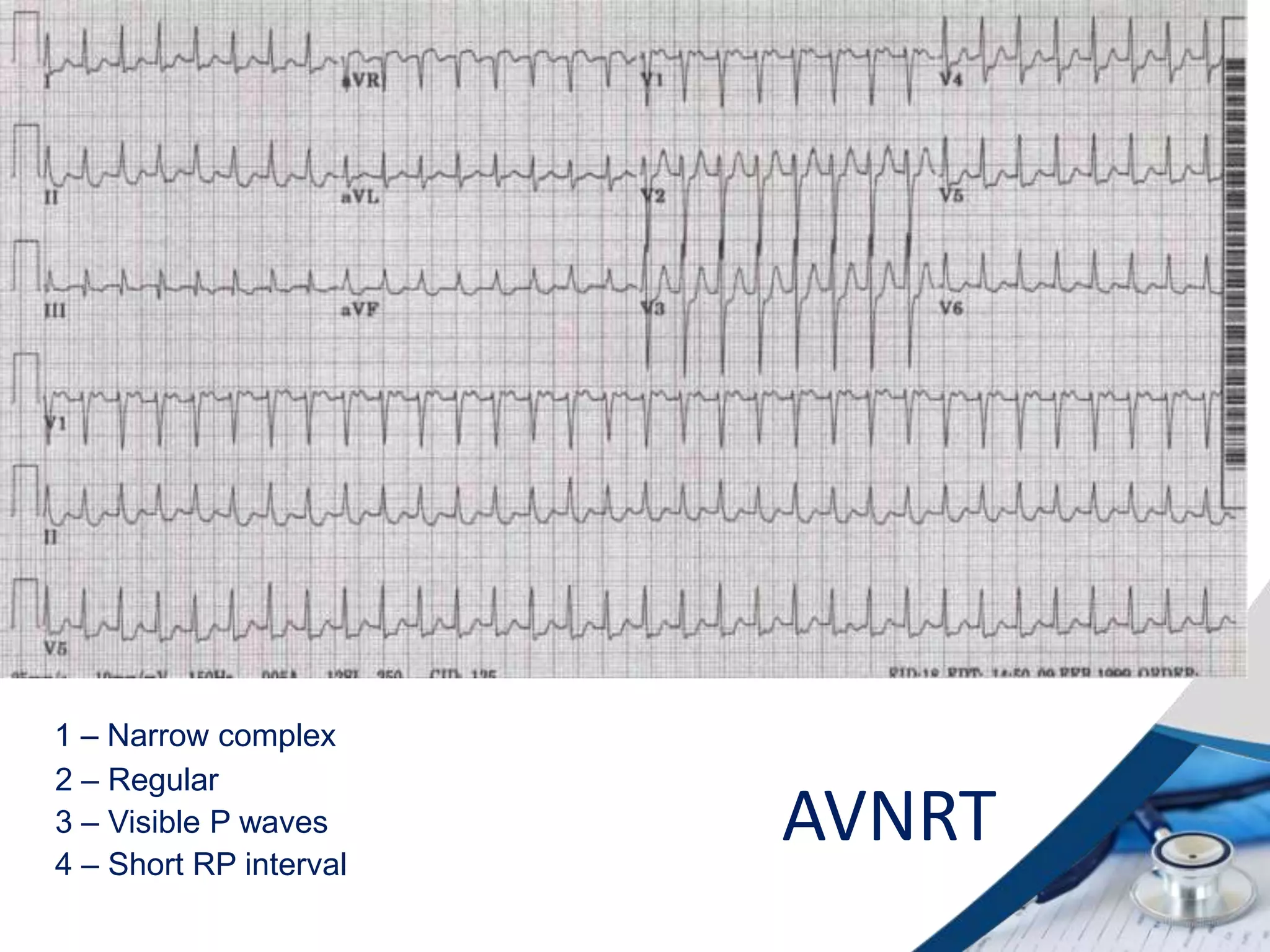 Introduction to Electrophysiology - Ventricular Arrhtyhmias and Cardiac ...