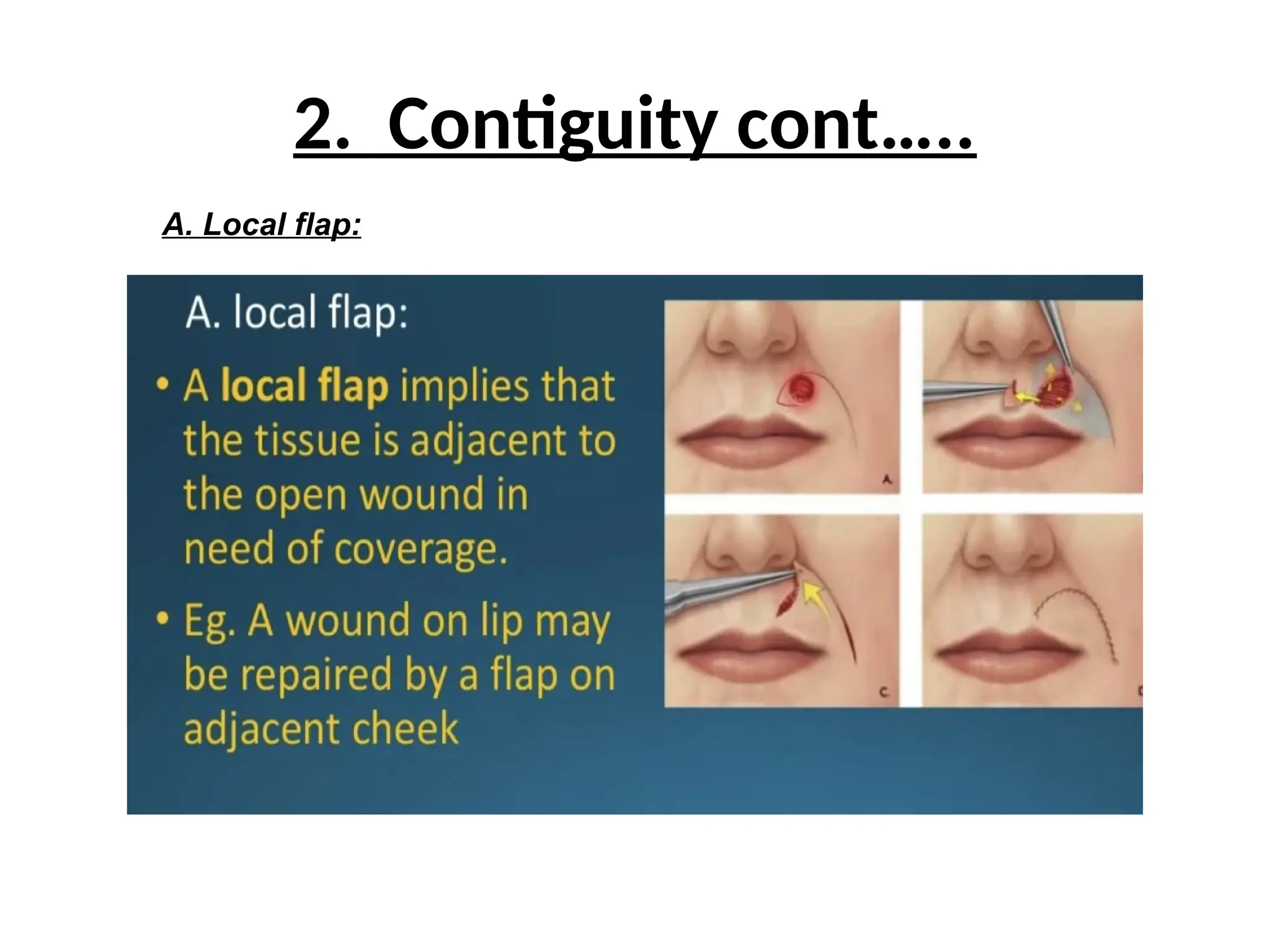 introduction to flaps presentation pptx. | PPT