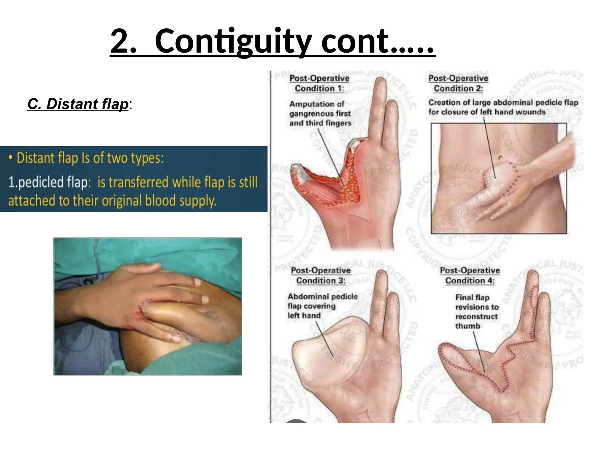 introduction to flaps presentation pptx. | PPT