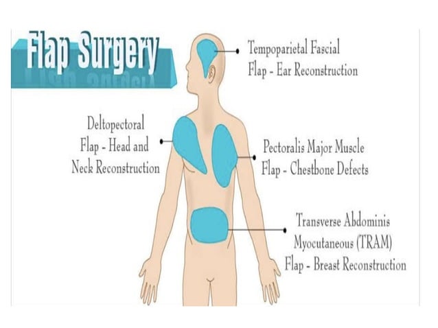 introduction to flaps presentation pptx. | PPT