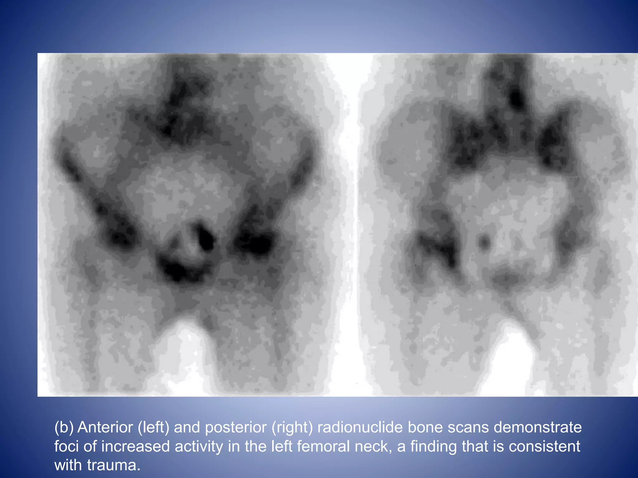 Introduction to Bone Scan: Techniques and Diagnosis | PPTX