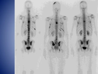 Introduction to Bone Scan: Techniques and Diagnosis | PPTX